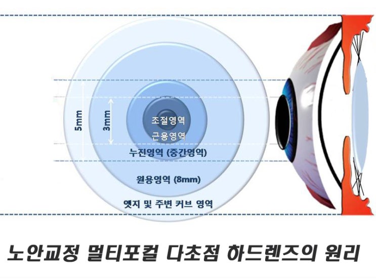 높은 난시에서 멀티포컬 소프트렌즈보다 멀티포컬 하드렌즈가 더 좋은 이유 네이버 블로그