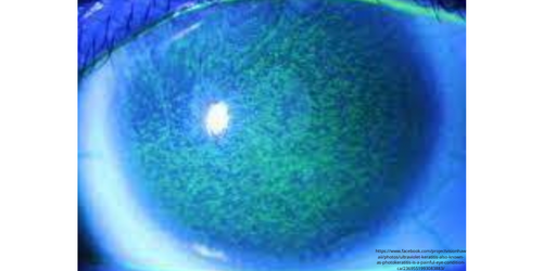 [안과의사가 말하는 안과정보] [인천안과/부평안과] 낚시후 눈 통증 (연세바른안과) : 네이버 블로그