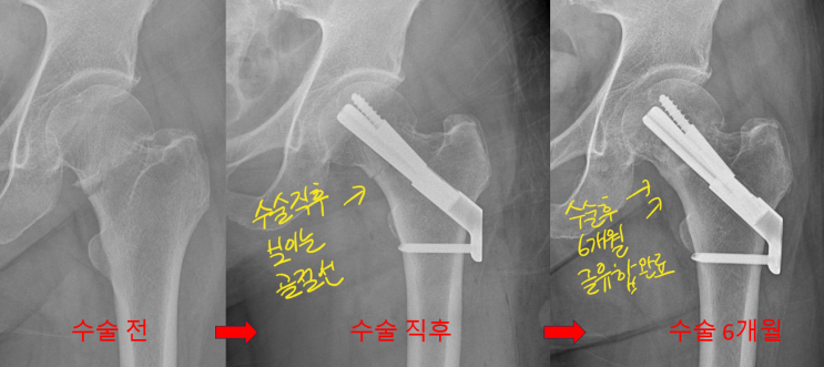 고령의 대퇴경부골절고관절골절 금속고정을 해야하나요 아님 인공관절을 해야하나요 금속고정과 인공관절수술의 장단점 노인