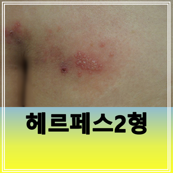 여자 헤르페스 2형 원인 증상 전염 성병 치료 완치 네이버 블로그