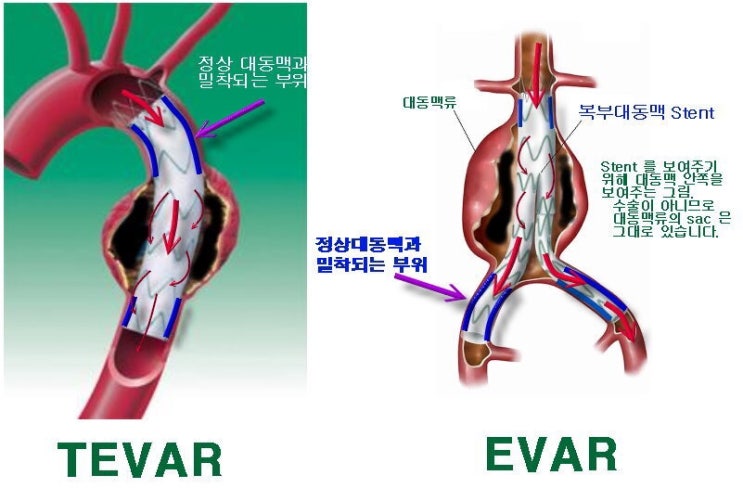 TEVAR & EVAR 정리 : 네이버 블로그