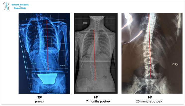 성장기의 측만증 어린이에게 적용한 측만증 운동에 관한 논문 리뷰 : 네이버 블로그