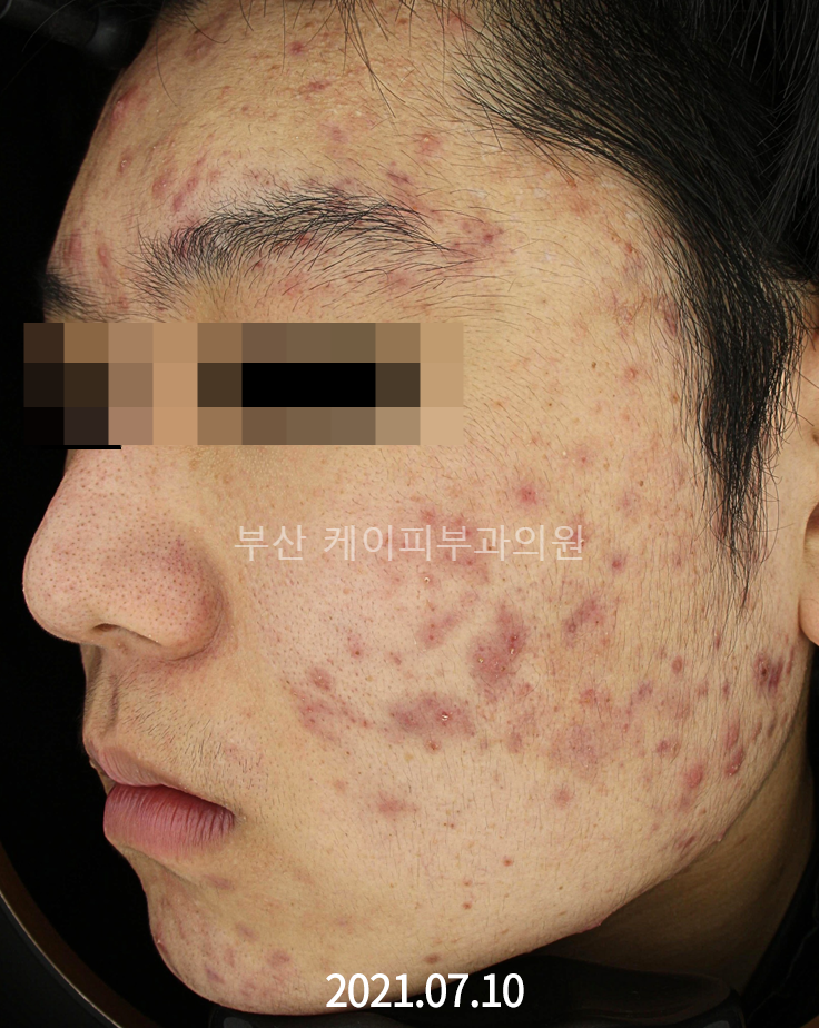 부산 여드름약 이소티논이소트레티노인 명현현상 및 효과 부작용 줄이는 방법 네이버 블로그