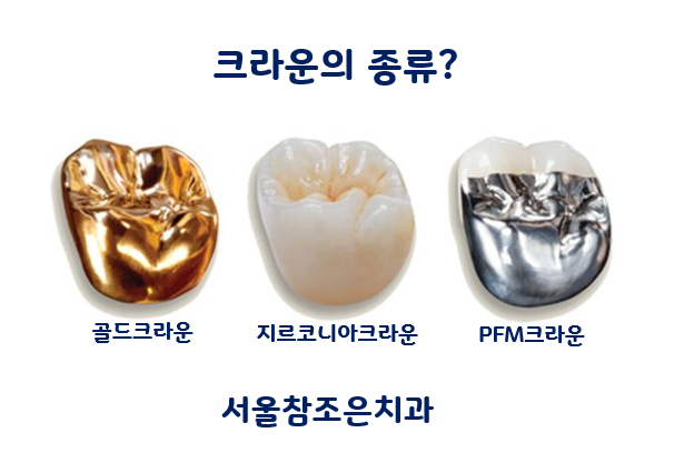 건대치과 크라운 종류와 장단점이 궁금해요pfm 크라운 골드크라운 지르코니아 크라운 네이버 블로그