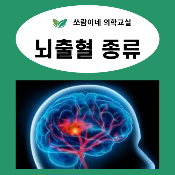 뇌출혈 종류 부위 의학용어 SDH SAH ICH IVH EDH 뜻 증상 치료 원인 : 네이버 블로그