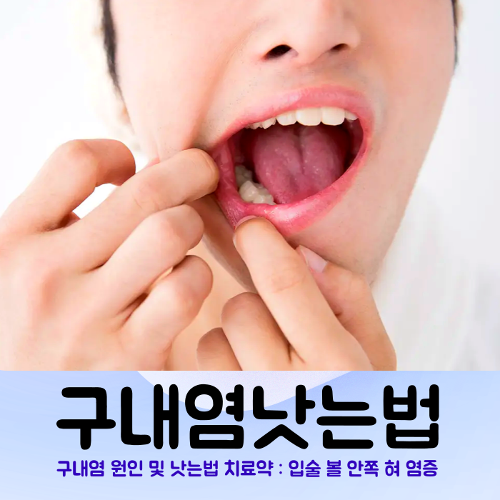 구내염 빨리 낫는법 입술 볼 안쪽 혀 염증 입병 구내염 약 알보칠 페리덱스 연고 아프타치정 사용법 네이버 블로그