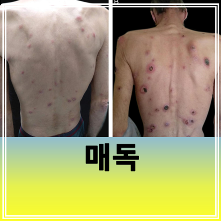 남자 여자 매독 초기증상 잠복기 완치 성병 네이버 블로그
