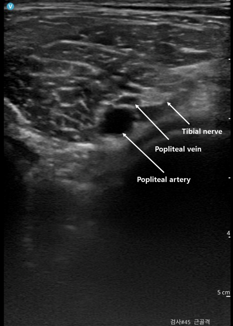[무릎 초음파] Posterior knee-2 (popliteal fossa, popliteal artery, popliteal ...
