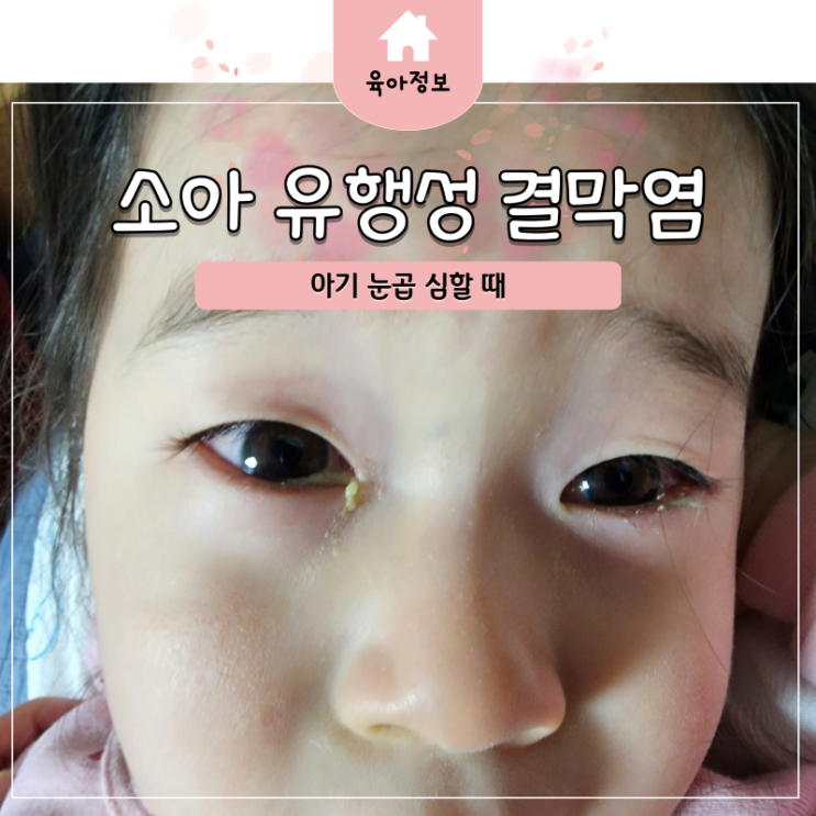 아기 눈곱이 심할때 전염성이 강한 소아 유행성 결막염 네이버 블로그