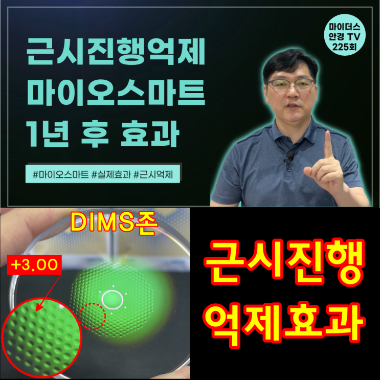 마이오스마트 근시 진행 억제 렌즈 사용 효과 1년 그리고 6개월 후 시력 변화 ㄴㄱㅌㅇ ㄴㄱㅇㅅ 네이버 블로그