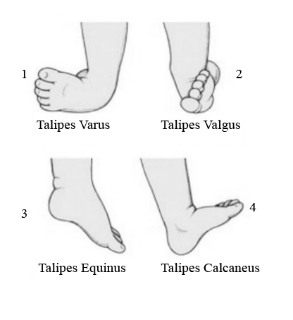 신생아 외반족 중앙대병원 최인호교수님 진료 후기, 마사지 방법 +경과 추가 : 네이버 블로그
