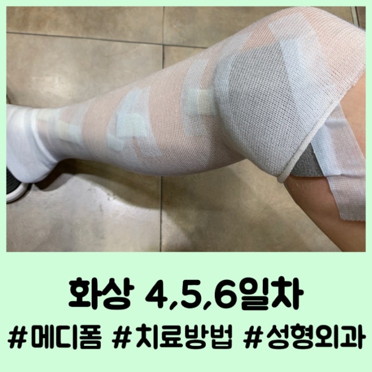 화상 4 5 6일차 심재성 2도 화상 메디폼 성형외과 진료 실손보험청구 가능 실비 비급여 항목 접촉성 피부염