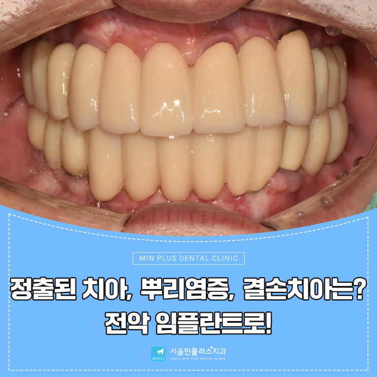 강북구치과 정출된 치아 뿌리염증 결손치아 는 어떻게 해결할 수 있을까 전악 임플란트 네이버 블로그