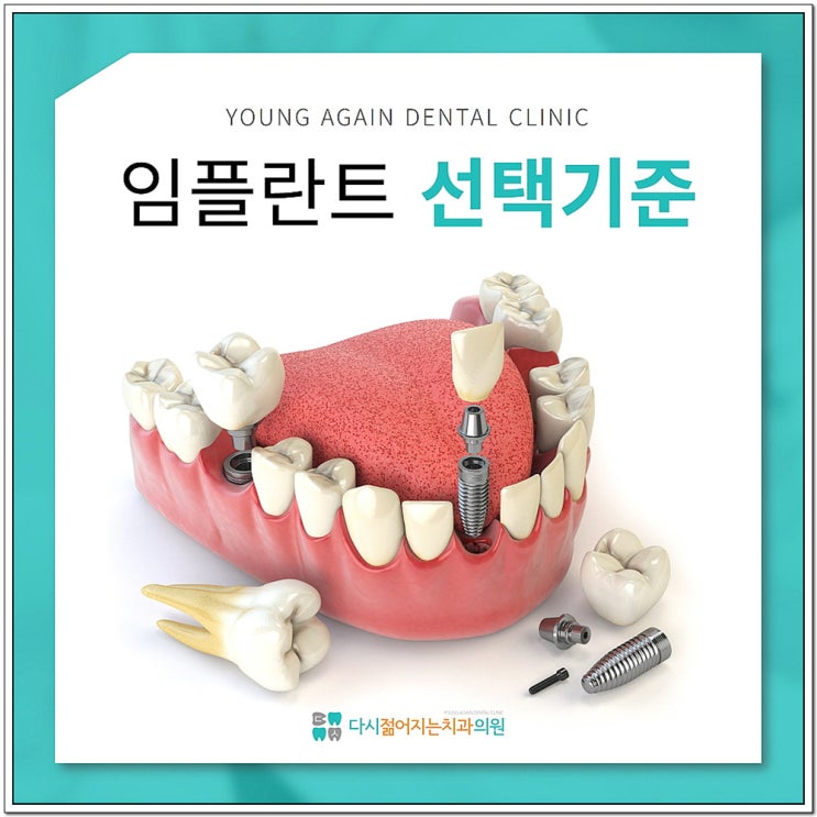 임플란트치과 선택이 고민된다면 네이버 블로그