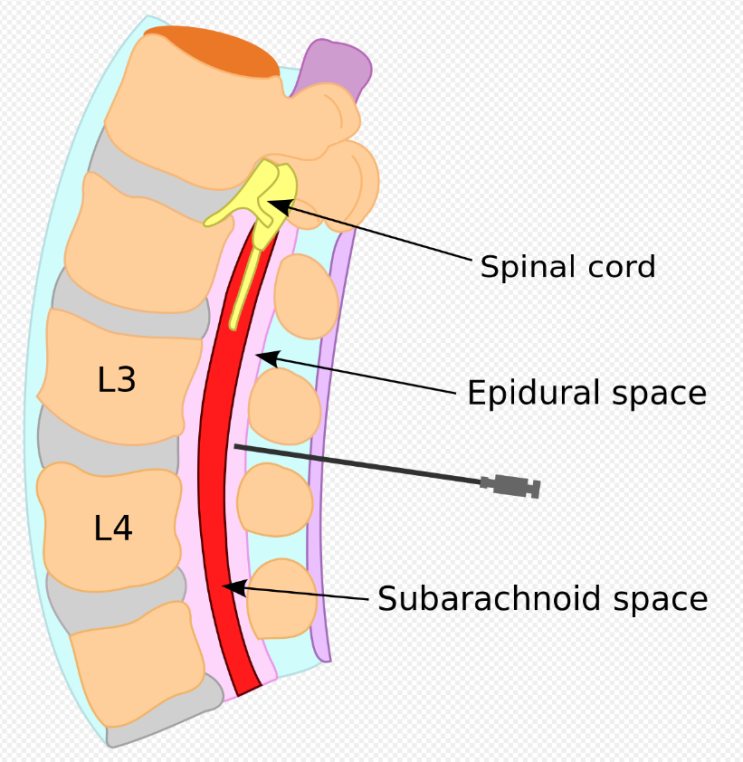 경막외패치술 Epidural blood patch 적응증 /경막천자후 두통(PDPH) 코드 등 : 네이버 블로그