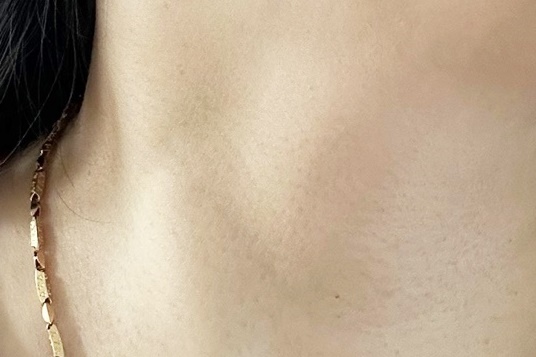 목 뾰루지 점점 안 생겨 : 네이버 블로그