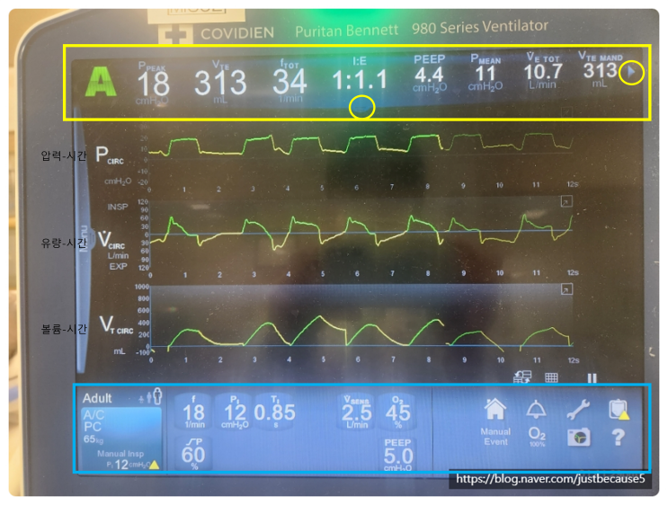 인공호흡기 화면의 이해_PB980 : 네이버 블로그