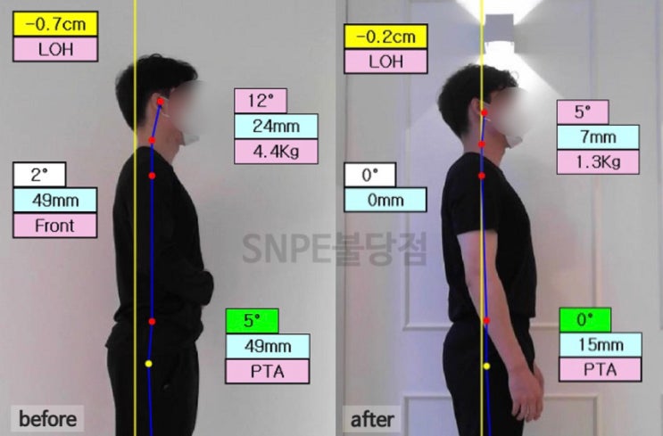 SNPE 불당점 거북목 탈출 성공사례 : 네이버 블로그