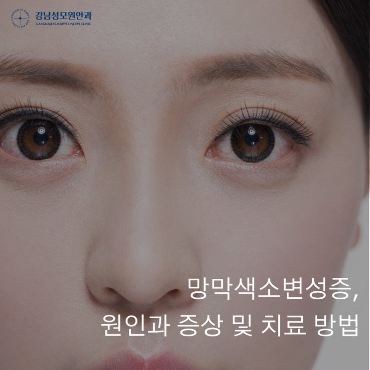 망막색소변성증 원인과 증상 및 치료 방법 네이버 블로그