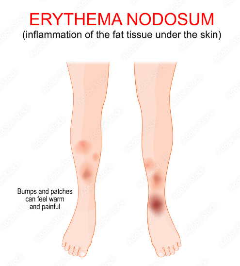 결절 홍반(Erythema nodusum) 치료 가능한가? : 네이버 블로그