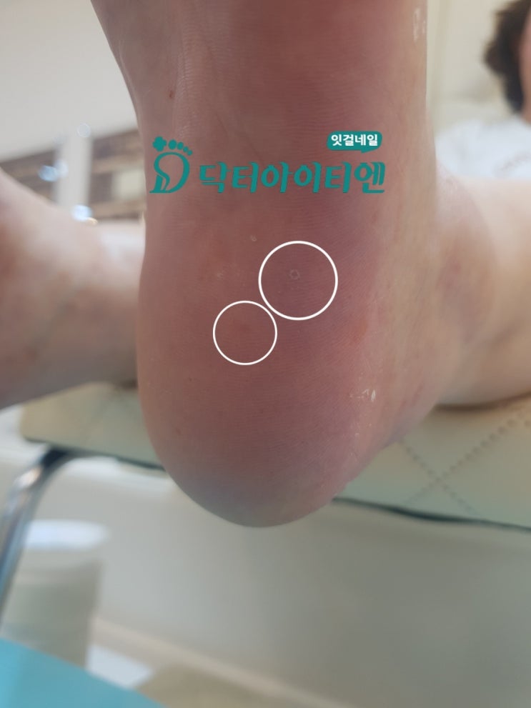 발바닥 빨간점, 동그란각질 수포형무좀각질 형태 : 네이버 블로그