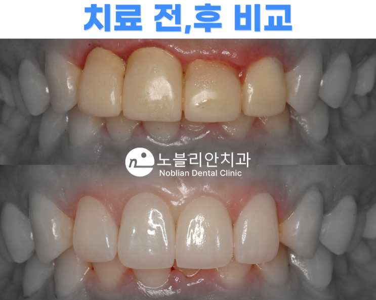 이에도 황금비율이 존재한다 치은 치조골 성형을 동반한 앞니 심미보철 치료 과정 부천 노블리안치과 네이버 블로그