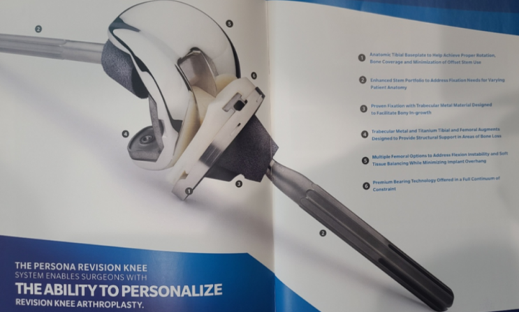Knee- Revisional TKRA (persona revision knee) : 네이버 블로그