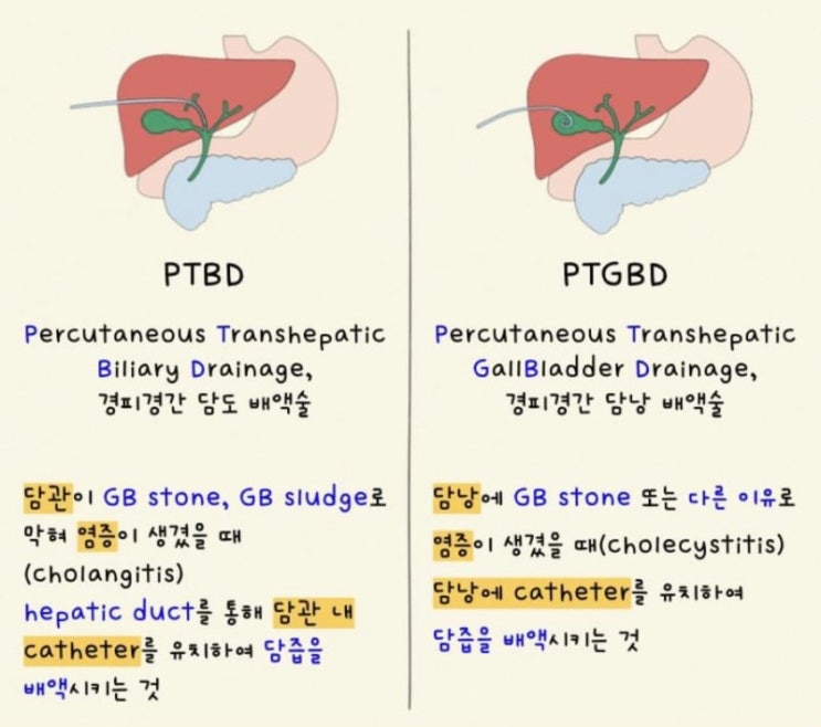 [IM RN] 의학용어 PTBD, PTGBD : 네이버 블로그