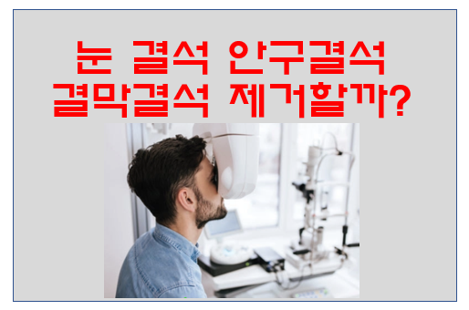 눈 결석 안구결석 결막결석 눈에 생긴 돌 없애야 하나요 제거 이유 And 방법 5가지 공개 암사동 현대백화점 근처 천호역 그랜드