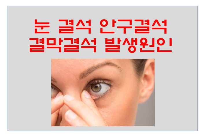 눈속에 돌이 나타났다 눈 결석 안구결석 결막결석 발생 원인 5가지 천호동 근처 천호역 그랜드성모안과 네이버 블로그