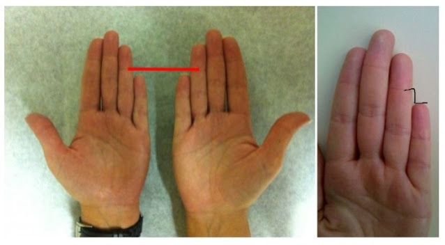 (HandReading)브럴리사인(Braly's sign)_글루텐 민감성 테스트(새끼손가락 길이로 측정) : 네이버 블로그
