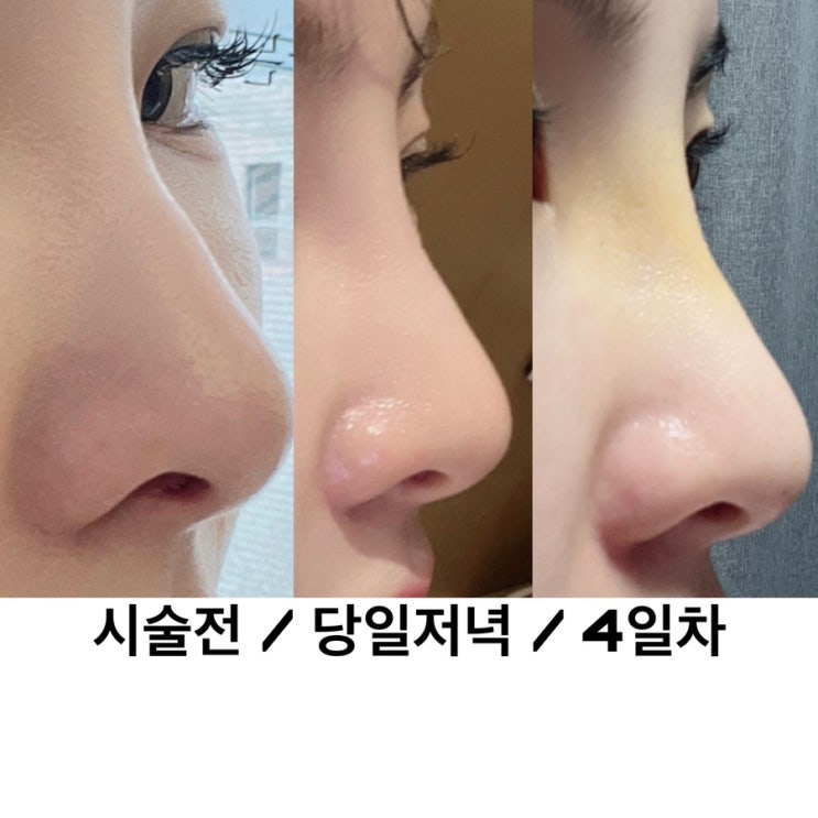 코실리프팅 벌써 2주차 마지막 후기! 이질감 불편함이라곤 1도없는 레이디코 : 네이버 블로그