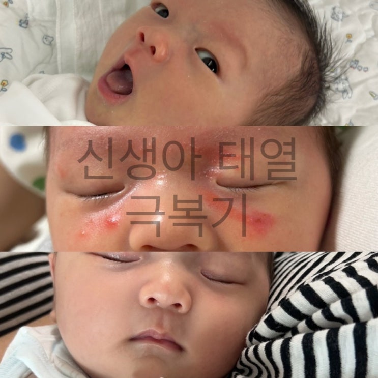신생아 시절신생아태열아기태열잡기태열보습리도멕스연고태열로션몽디에스수딩젤쁘리마쥬크림 네이버 블로그