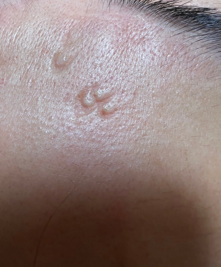 부천 송내 피부관리손님 피지가 꾸준히 있는 편이세요 9년다닌 손님 부천상동피부관리실 스킨엔 네이버 블로그