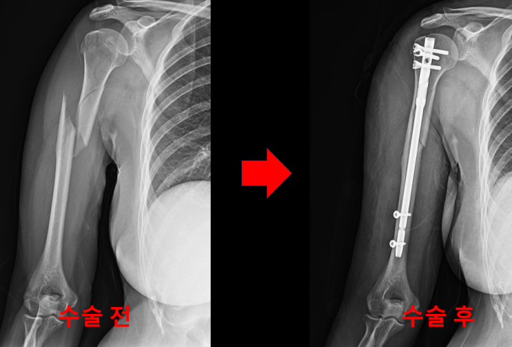 위팔뼈 어깨에서 팔까지 이어지는 심한 골절 상완골 간부골절 Humerus Shaft Fracture 금속정으로 우수한