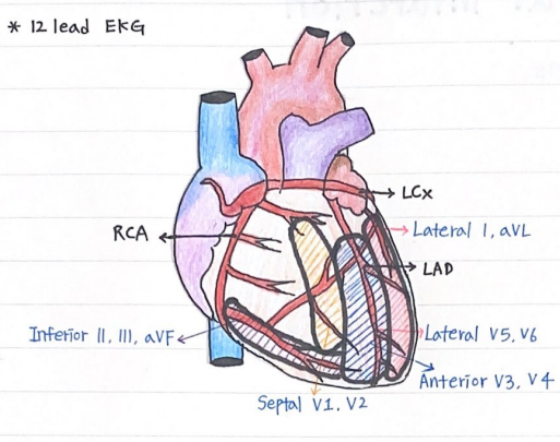 응급실 : 급성심근경색(MI, AMI, STEMI, NSTEMI) 환자 간호(실무 중심) : 네이버 블로그
