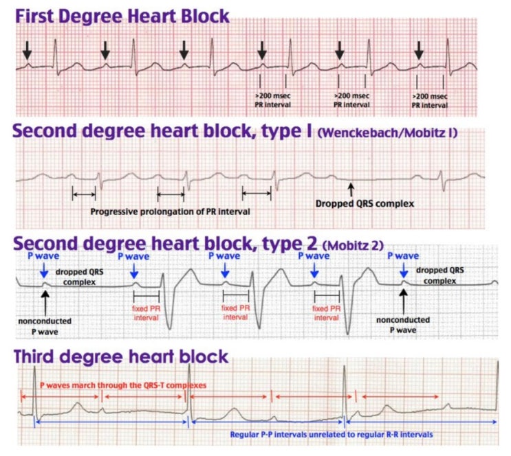 AV block 방실차단 쉽게 공부하기 : 네이버 블로그