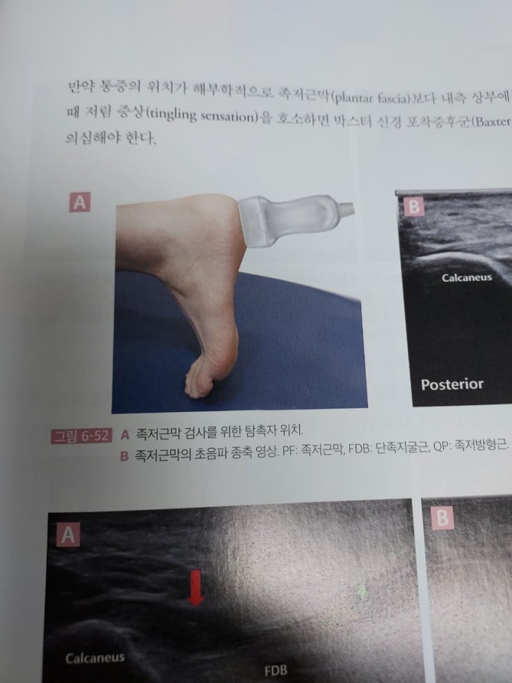 Plantar fascitis : 네이버 블로그