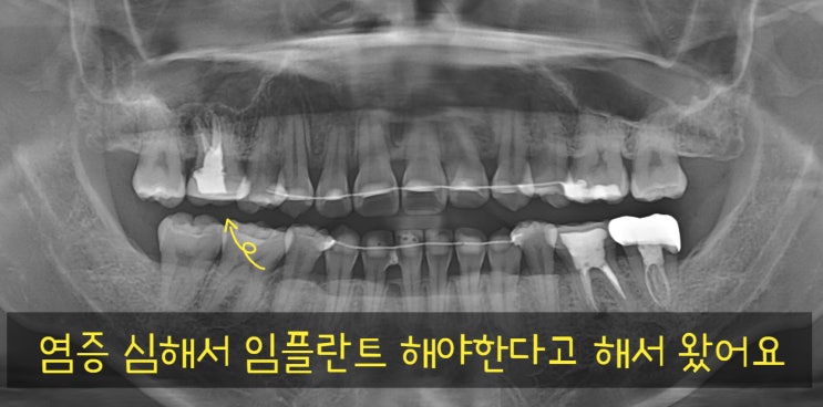 임플란트하려고 했던 치아 재신경치료로 살린 케이스 고름 나오는 치아 신경치료 네이버 블로그