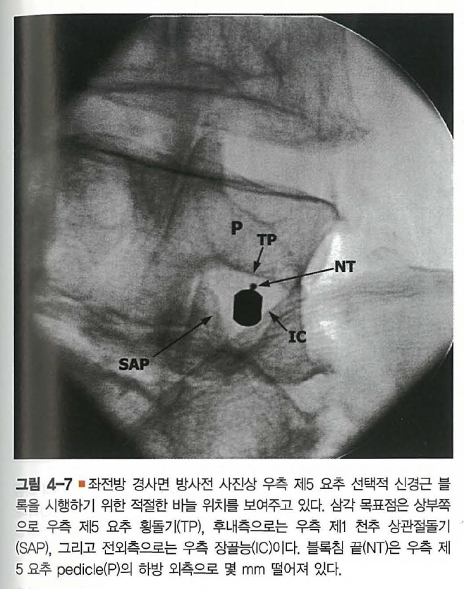 [외래/주사/척추]L-SNRB Selective Nerve Root Block /transforaminal block ...