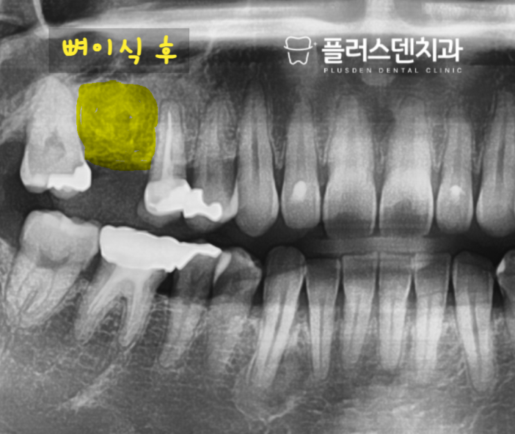 전농동치과 에서 뼈가 얇은 환자에게 시행하는 수술 테크닉 광범위한 뼈이식gbr은 실력좋은 플러스덴 전문의에게~ 네이버 블로그
