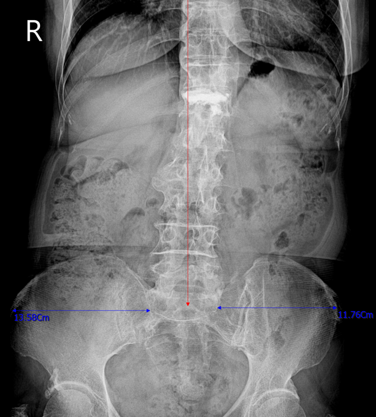 Lumbar lordotic curve, Pelvic In Ex : 네이버 블로그