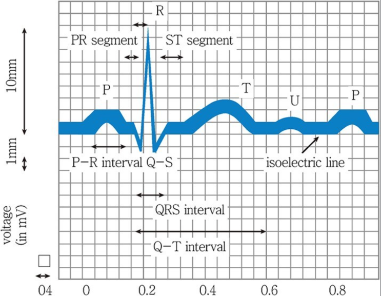 심전도_심방세동 심실빈맥 심실세동(A fib,V tack,V fib) : 네이버 블로그