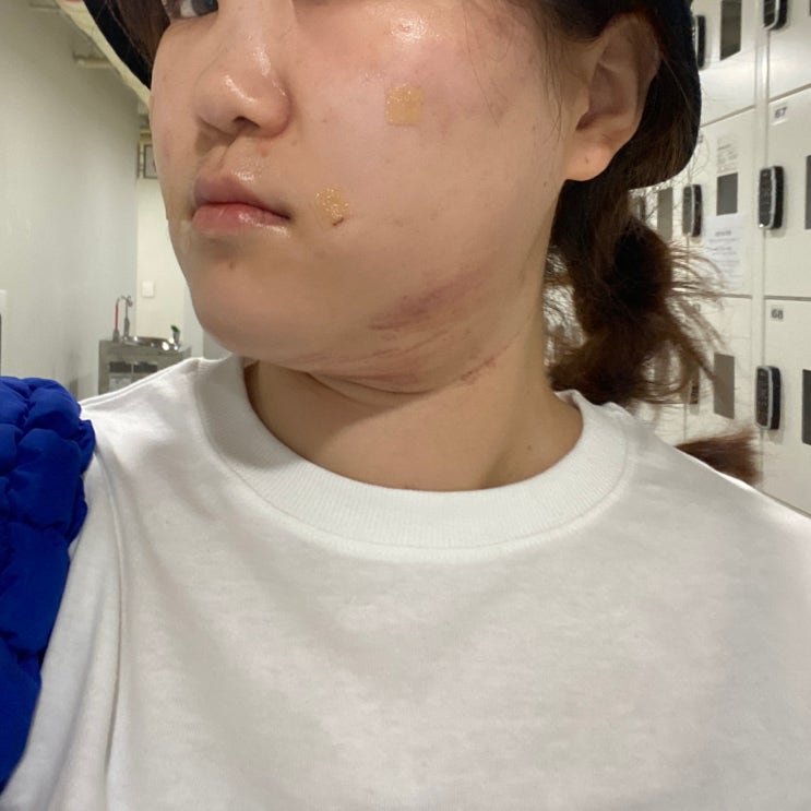 신사 피부과_눈물고랑 울트라콜200+인모드 동시 시술받은 후기/붓기와 고통/3일차 후기 : 네이버 블로그