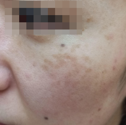 오타양모반 (ABNOM) 치료 case review : 네이버 블로그