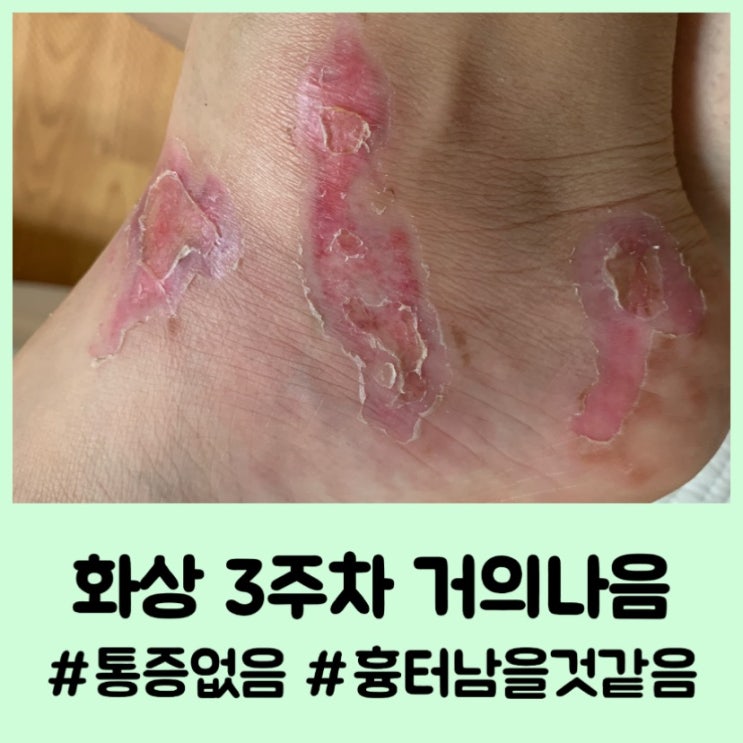화상 실비 실손 보험청구 서류 3주차 기록 흉터는 남았지만 상처는 거의 아물었어요 네이버 블로그