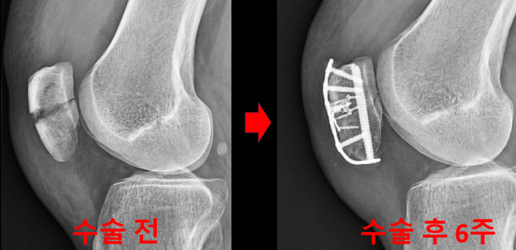 슬개골골절patella Fracture 언제부터 걷고 무릎을 구부릴수 있나요 심한 무릎통증을 유발하는 무릎뼈골절