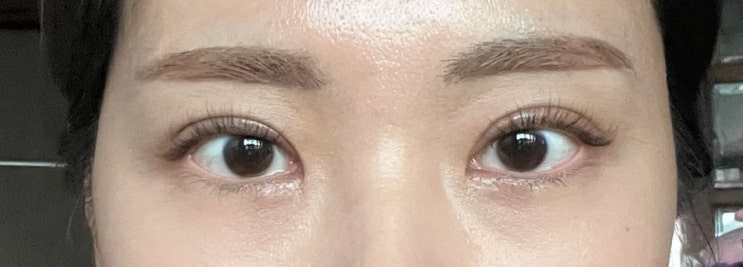 눈 쌍수 절개 재수술 눈매교정윗트임1달차~6주차후기이마 보톡스 네이버 블로그