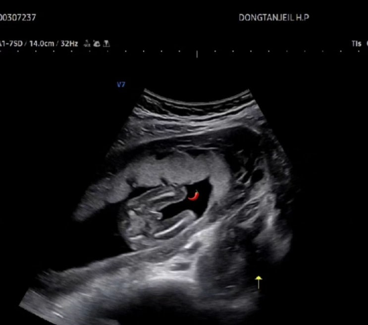 임신13 16주 동탄제일병원 2차기형아검사• 맘편한임신 철분 • 미즈톡톡 페이백 • 국내여행 • 16주차 변화 네이버 블로그