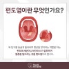 급성 편도염 증상 편도염 낫는 법 편도염 수술 네이버 블로그